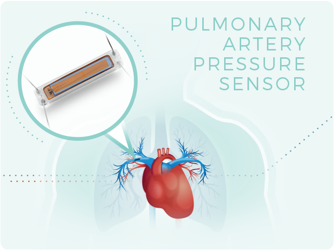 Cordella System for Hemodynamic Monitoring - Endotronix endotronix